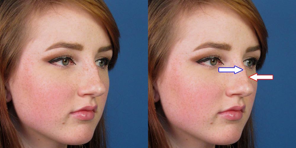 از بین بردن قوز بینی در خانه | چگونه قوز بینی را برطرف کنیم |دکتر ...